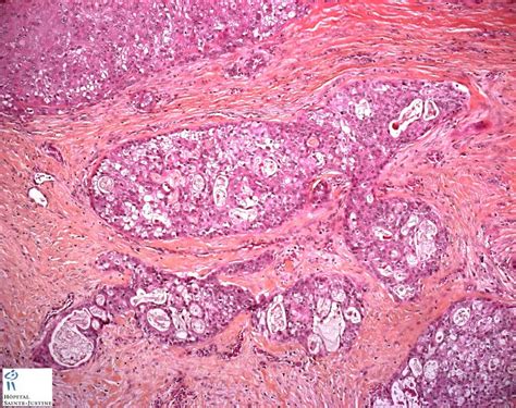 Epidermoid Carcinoma