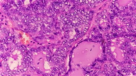 Non Small Cell Lung Cancer Screening Gives Hope For Surviving