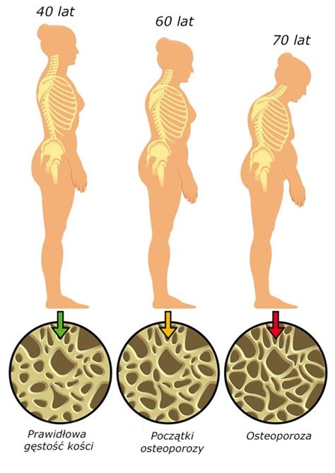 Osteoporoza Jak Leczyć Alfa Lek Lecznica Profesorko Ordynatorska