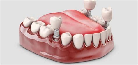 Full Mouth Dental Implants 3 Types That Can Restore Your Smile Dr