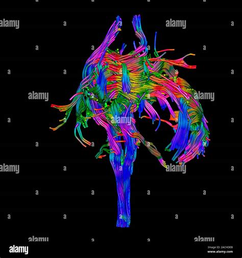 Brain Tumour Coloured 3d Diffusion Tensor Imaging Dti Scan Of The
