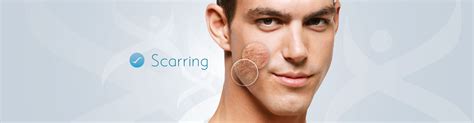 Facial Scar Treatment Scars Lesions Blemishes Preventous