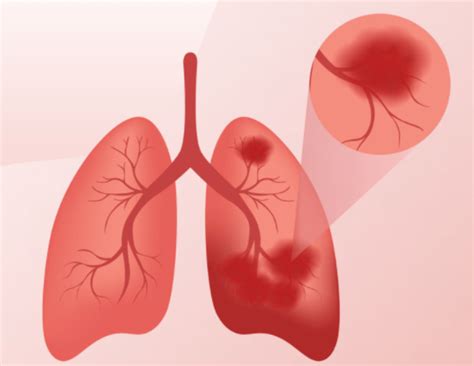 正元堂结减：肺部结节是怎么形成的？ 知乎