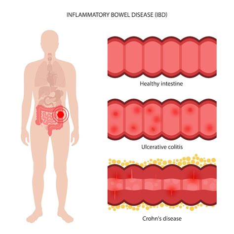 Premium Vector Inflammatory Bowel Disease