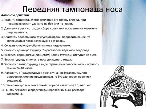 Носовые кровотечения - презентация онлайн