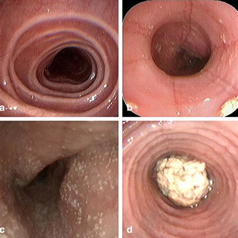Endoscopic Images Showing Common Features Of Eoe In Adults A