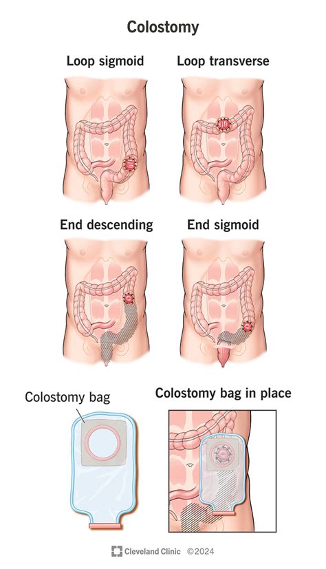 Loop Colostomy Reversal