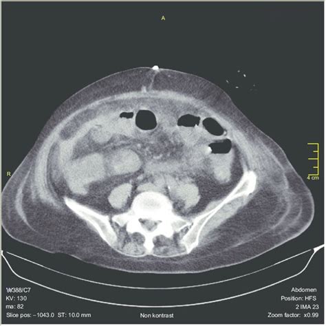 Hinchey Classification Download Table