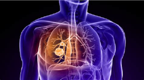 Nsclc Actionable Biomarkers And Their Impact On Treatment Mycme