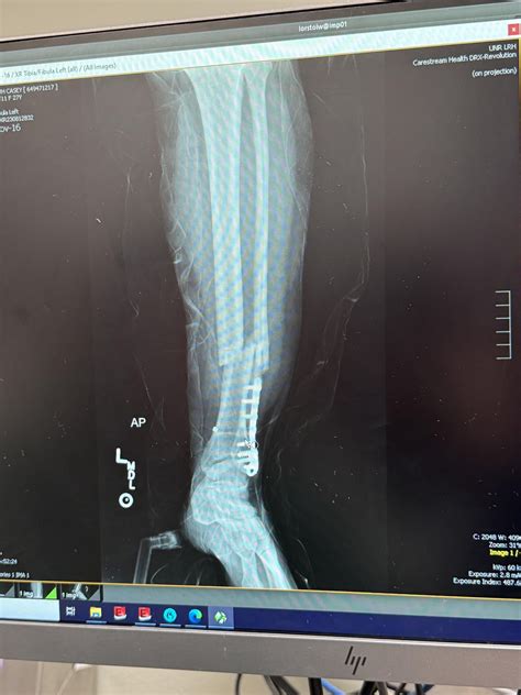 I Broke My Tib Fib Again Above My Previous Hardware Rmedizzy
