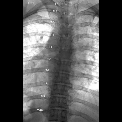 Selective Nerve Root Block Thoracic Spine Clinical Tree Selective Nerve Root Block Thoracic Spine Clinical Tree