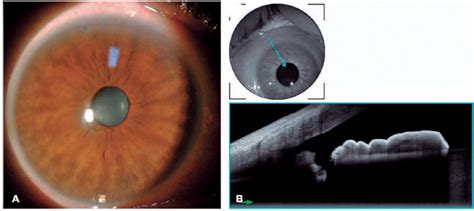 Scielo Brasil Swept Source Optical Coherence Tomography Detects