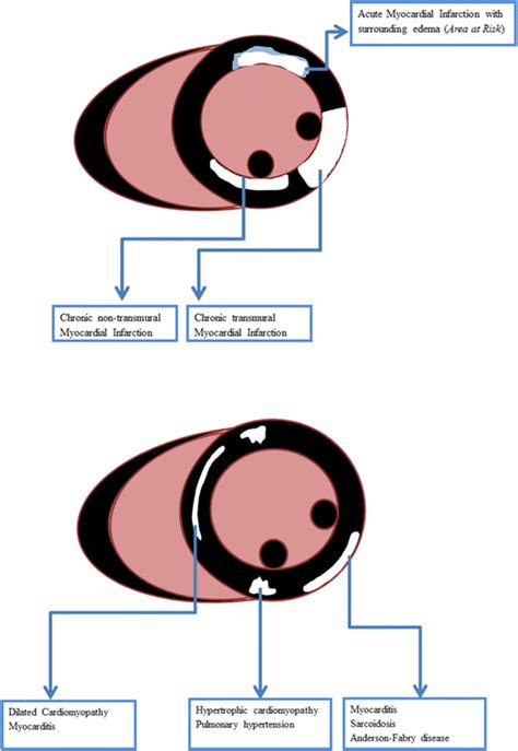 Distribution And Pattern Of Delayed Myocardial Enhancement In Different