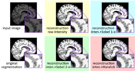 Comparison Of The Segmentation Reconstruction In Oasis Dataset Using
