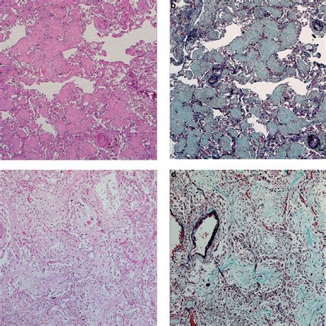 Diffuse Alveolar Damage Pattern Of Lung Injury In SARS Patients A Download Scientific