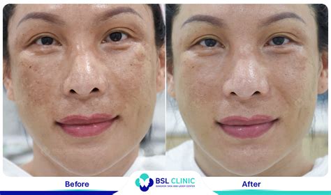 Melasma Treatment Results Before And After At Bsl Clinic