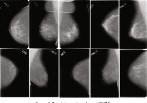 Figure 1 From Breast Cancer Classification From Mammogram Images Using Extreme Learning Machine