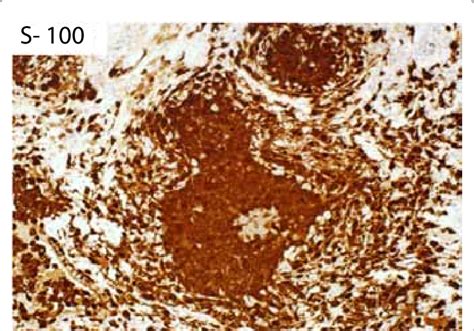 Immunohistochemistry For Cd1a Demonstrates Staining Of Langerhans Cell