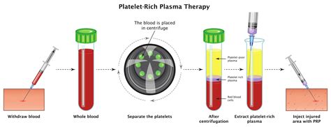 Platelet Rich Plasma Injections Prp Everything You Need To Know