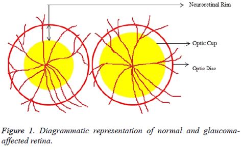 Computational Intelligence Based Decisio Biomedical Research