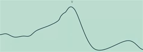 Threshold Auditory Brainstem Response Abr Testing Interacoustics