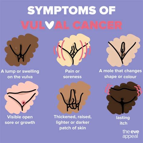 Vulva Cancer St Andrews House Medical Centre Vulva Cancer St Andrews House Medical Centre