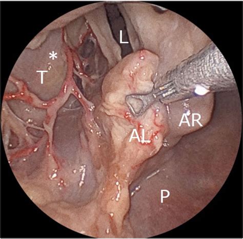 Left Sla Separated From The Perichondrium Of The Thyroid Plate By A Download Scientific Diagram