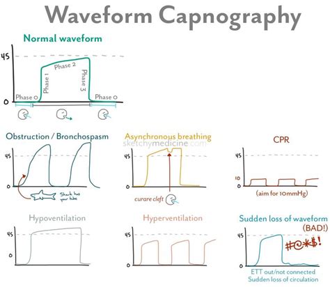 Waveform Capnography Is A Commonly Used Monitor In The Operating Room