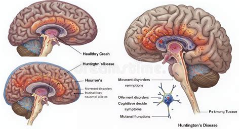 Huntington S Disease Detailed Brain Cross Sections Showing Neuron