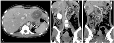 Afferent Loop Obstruction In A 35 Year Old Woman After Billroth Ii Download Scientific Diagram
