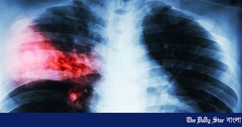 নিউমোনিয়ার ঝুঁকিতে কারা লক্ষণ কী The Daily Star Bangla