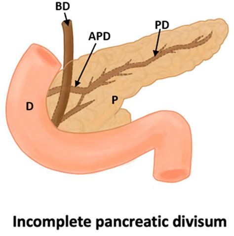 Pancreas Divisum Causes Symptoms Diagnosis Treatment And Prognosis