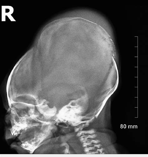 Caput Succedaneum Radiology
