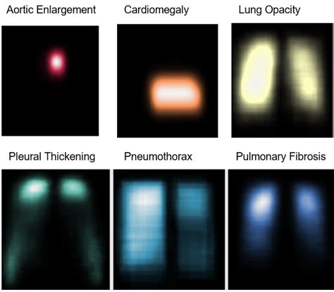 Abnormality Detection In Chest X Rays CXR Detecting Abnormalities In Chest X Rays Using