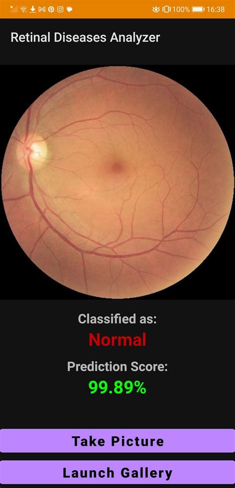 Github Jackaquamin 4 Classes Retinal Diseases Classification