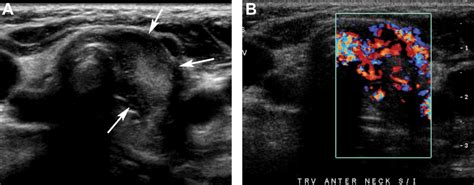 Surveillance Neck Sonography After Thyroidectomy For Papillary Thyroid