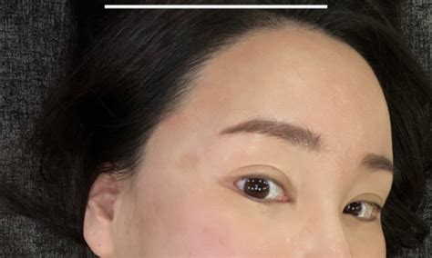 안산 중앙역 피부과 리팟레이저 흑자제거후기 가격 공유 네이버 블로그