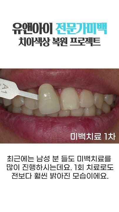 고농도 미백제를 활용한 치아 색상 개선 전문가미백치료 Youtube