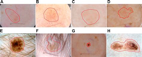 Frontiers Sl Hardnet Skin Lesion Segmentation With Hardnet