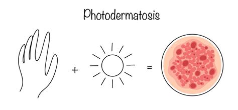 Heat Rash Royalty Free Vector Image Vectorstock