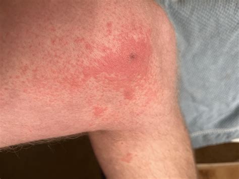 Poison Ivy Or Bug Bite Rdermatologyquestions