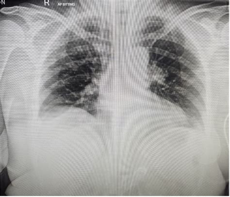 Segmentectomies Made Easy Series Robotic Assisted Left S1 S2 And S3