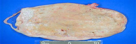 Pure Primary Ovarian Carcinoid Tumor International Journal Of