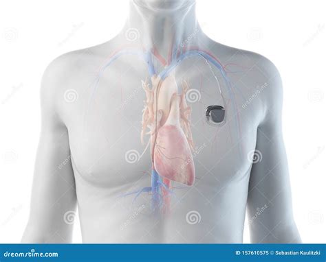 A Pace Maker Stock Illustration Illustration Of Inside 157610575