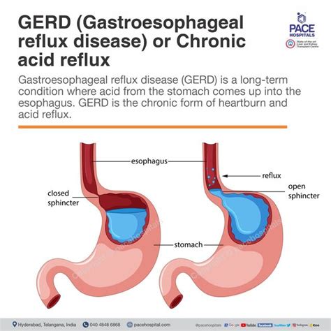 Gastro Esophageal Reflux Disease Causes Symptoms