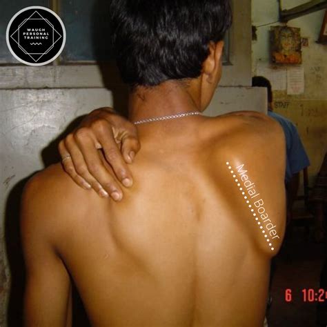 Fix Scapular Winging A Deep Dive Article To Correct Your Asymmetries Rposturetipsguide