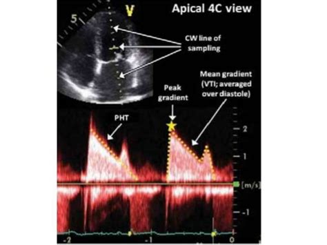 Echo Mitral Stenosis