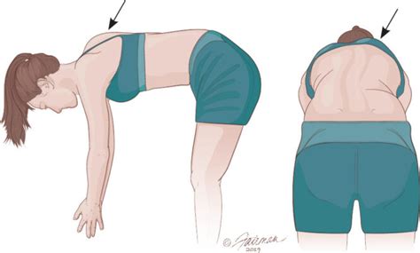 The Scoliosis Forward Bend Test Procedure Accuracy And