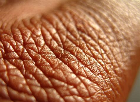 Could A Skin Odor Test Result In Early Diagnosis Of Parkinsons Disease Neuro Central