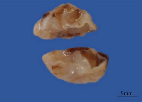 Macroscopic Image Of The Formalin Fixed Fragment Removed In The Biopsy Download Scientific